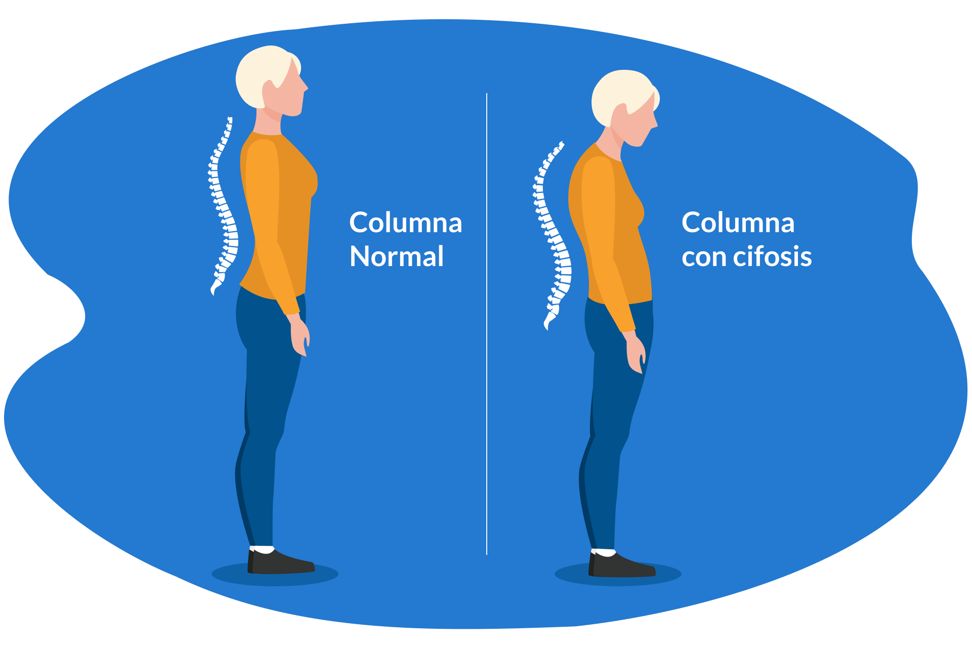 Cifosis: qué es, síntomas, causas y tratamiento 👨‍⚕️